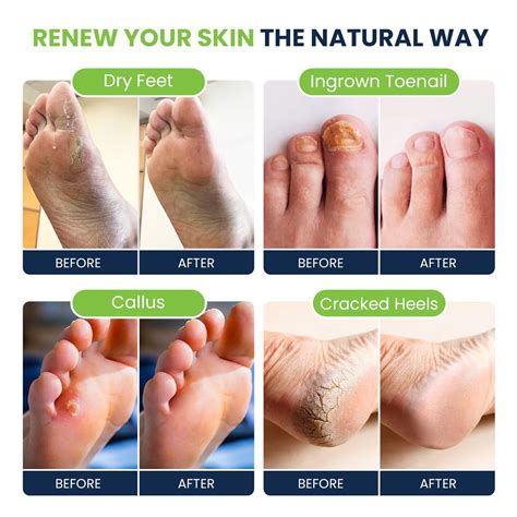 Tea Tree Oil Foot Soak With Epsom Salt Best Toenail Fungus Treatment