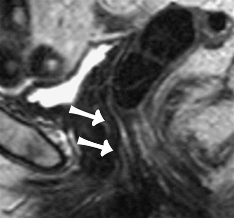 Mr Imaging Of The Uterine Cervix Imaging Pathologic Correlation