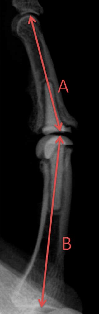 Proximal Interphalangeal Joint Semantic Scholar