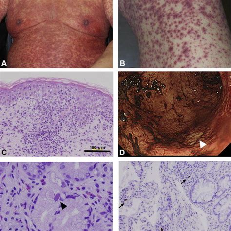 Clinical And Histopathologic Findings A Erythematous Rash On The Download Scientific Diagram