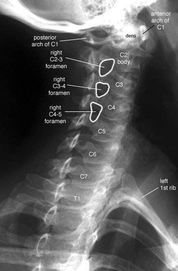 Radiographic Anatomy Of The Skeleton Cervical Spine Right Anterior Oblique View Labelled