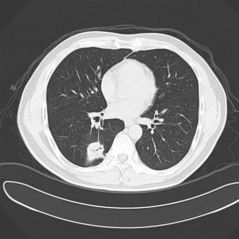 Cxr 胸部x光判讀 Lung Mass