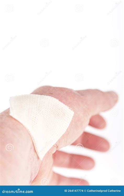 Chemical Burn On The Wrist Skin With Hydroxide Sodium Acid Household