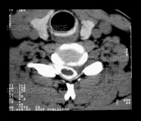 Photograph Ct Myelogram Cervical Disc Herniation Science Source Images