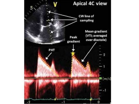Echo Mitral Stenosis Pptx Heart And Cardiovascular Diseases Diseases And Conditions