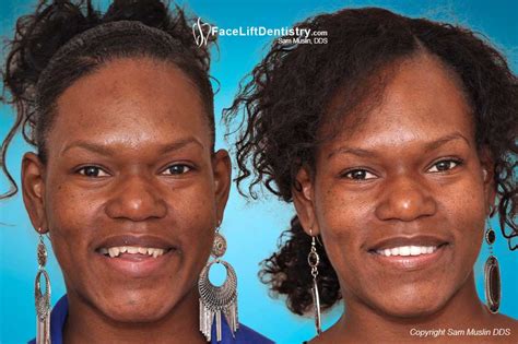 Open Bite Correction Treatment Without Surgery