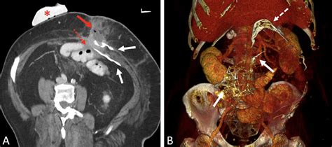 Bowel Perforation And Abscess Transaxial Ct Scan A And 3 D Download Scientific Diagram