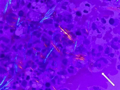 Diagnosis And Treatment Of Gout And Pseudogout For Everyday Practice