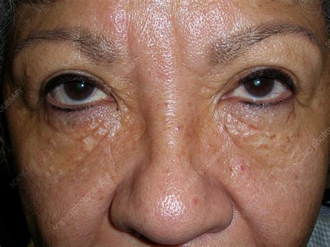 Syringomas Stock Image C056 5217 Science Photo Library