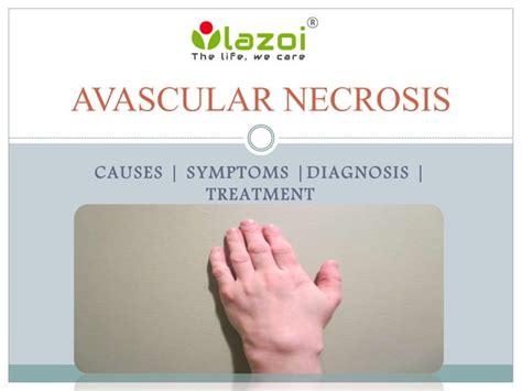 Avascular Necrosis Causes Symptoms Diagnosis And Treatment Ppt