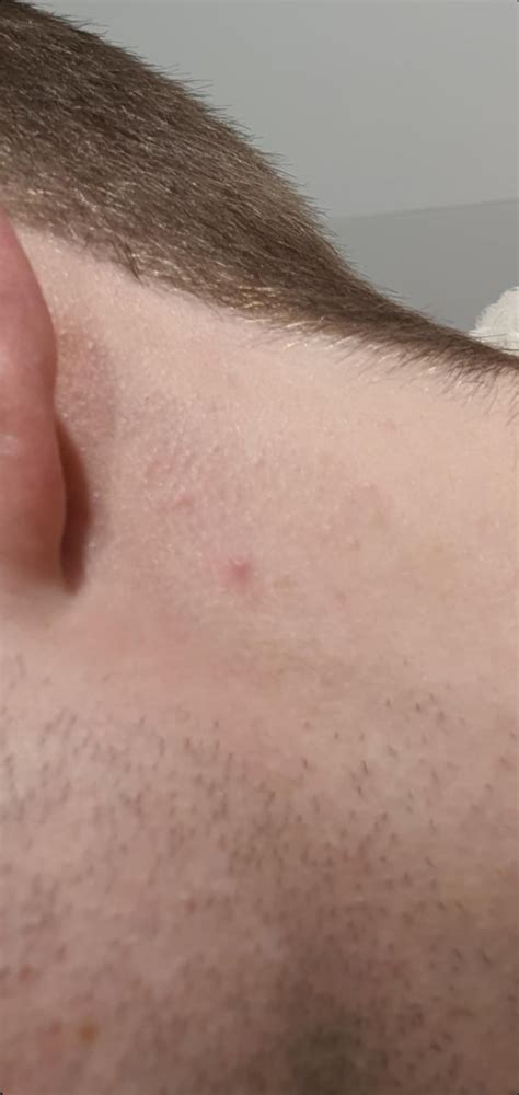 Unresponsive Texturepapulescomedonal Looking Bumps After A Year Of
