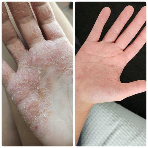 The Eczema Clinic Home Jacinta Mullins Is A Brisbane Naturopath That