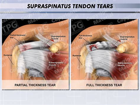 Supraspinatus Tendon Tear Treatment