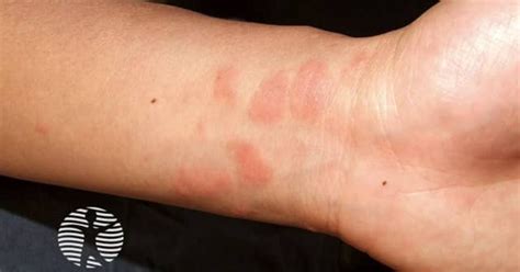 Contact Allergic Dermatitis Of The Arms And Legs Image