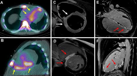 Figure2 99m Tc Pyrophosphate Scintigraphy Pyp And Cardiac Magnetic