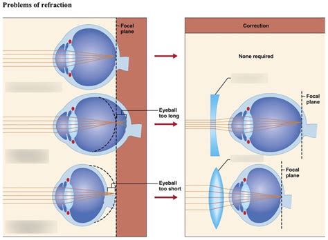 Emmetropic Myopic Hyperopic Eye Diagram Quizlet