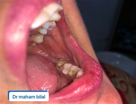 Crown Preparation Vs Crown Cementation Dr Maham Bilal