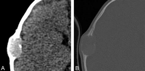 Axial Ct Images A And B Of The Head Demonstrating Cranial Fasciitis