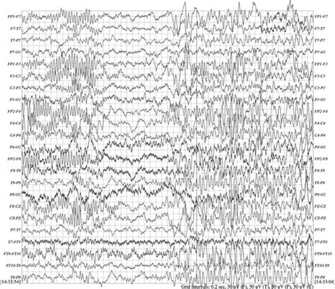 The Example Eeg Signals In Chb Mit Dataset Download Scientific Diagram