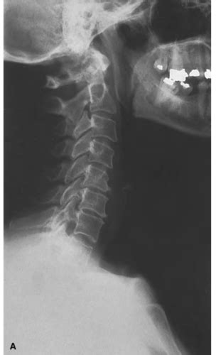 Cervical Imaging Flashcards Quizlet