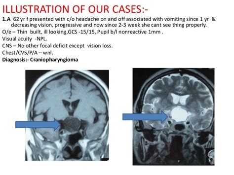 Supraorbital Craniotomy