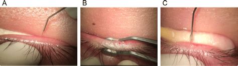 The Treatment Procedure And Structure Of Our Private Probe And Rinse