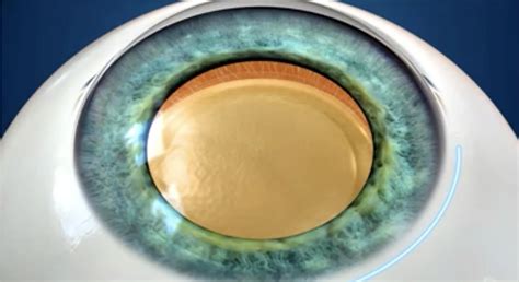 Intervento Di Cataratta Nuove Tecnologie Micro Chirurgia Oculare