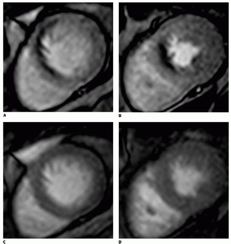 Myocardial Perfusion Imaging Mr Techniques Radiology Key