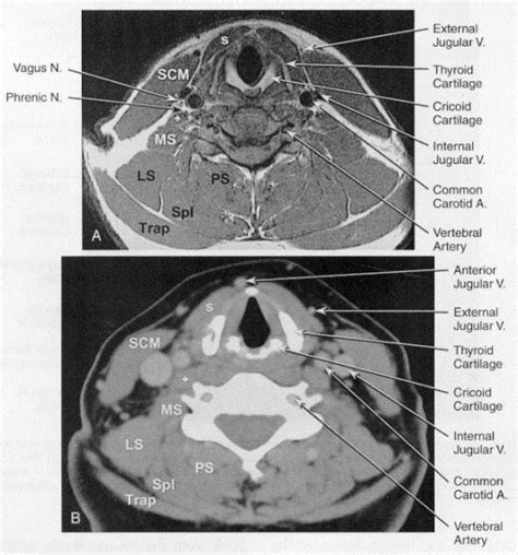 Normal Anatomy Of The Neck With Ct And Mr Imaging Correlation