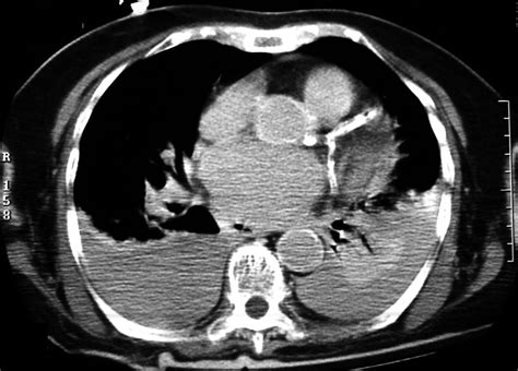 Lungs Fx Compressive Atelectasis Bilateral Pleural Effusions Dx Ddx Ct