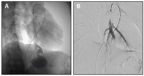 Use Of The Mvp™ Micro Vascular Plug System As A Single Occlusion Device