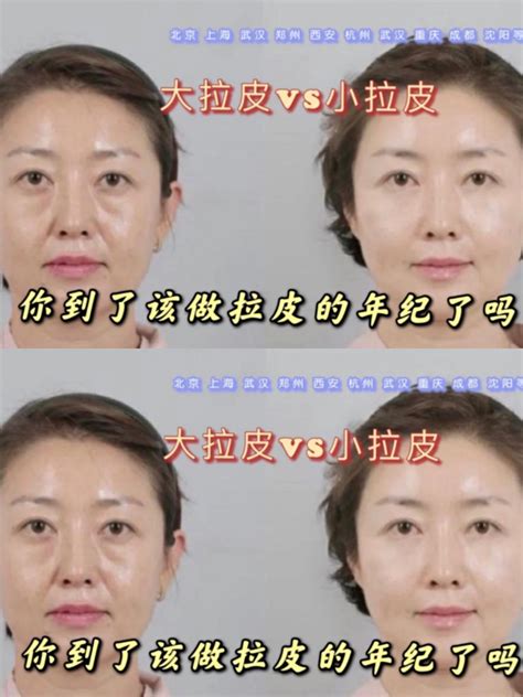 全国小拉皮大拉皮线雕抗衰医生（黑白名单合集） 知乎