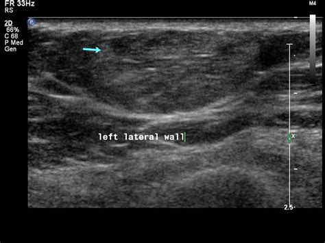 Atlas Of Breast Cancer Early Detection