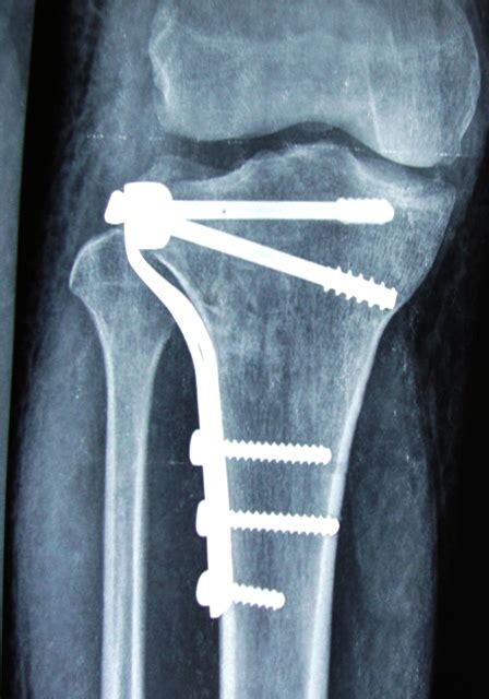 Xray Pictures Of Fractured Tibia Bone And Spine