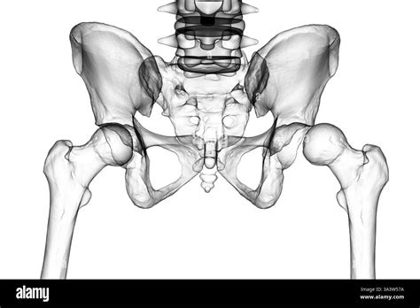 Illustration Of Hip Dysplasia Dislocation Type Showing Misalignment
