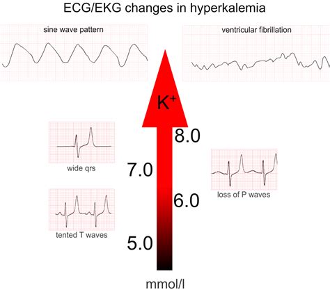 Hyperkalemia Ekg