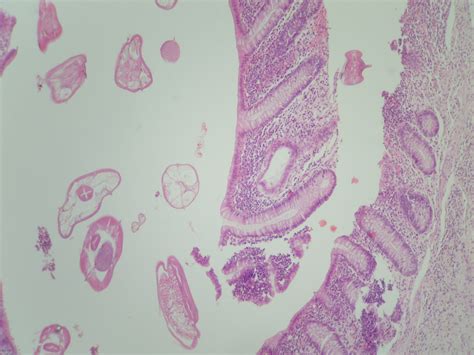 Appendix With Threadworm Doccheck