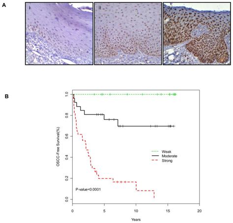 Ezh2 Promotes Malignant Phenotypes And Is A Predictor Of Oral Cancer Development In Patients