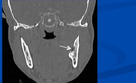 Coronal Reformat Showing Subtle Cortical Erosion As Seen On The Bone Download Scientific