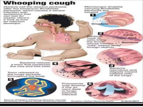 Diptheria Tetanus Pertussis Infection