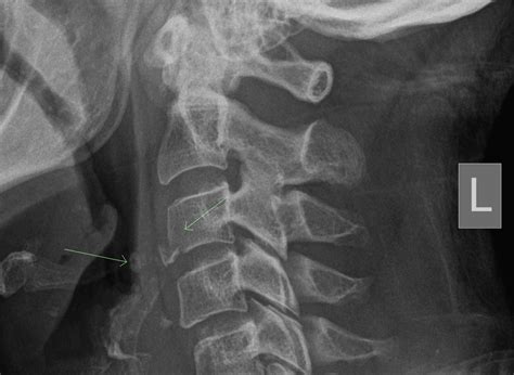 7th Cervical Vertebrae Fracture