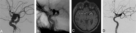 A Left Ica Angiogram Shows A Supraclinoid Aneurysm B Angiogram After