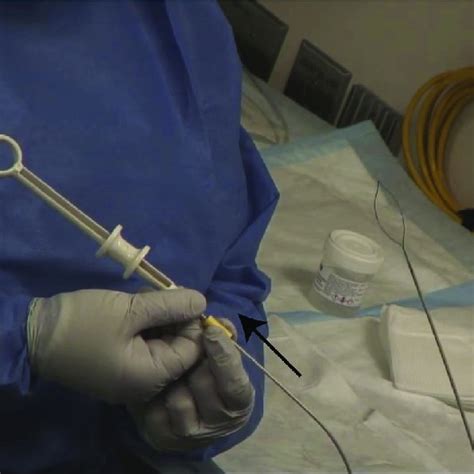 A Large Pedunculated Polyp With A Thick Stalk In The Gastric Antrum Download Scientific Diagram