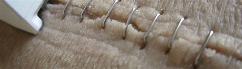Train REAL Llc Wound Closure