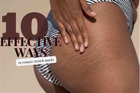 10 Effective Ways To Remove Stretch Marks Hoospital