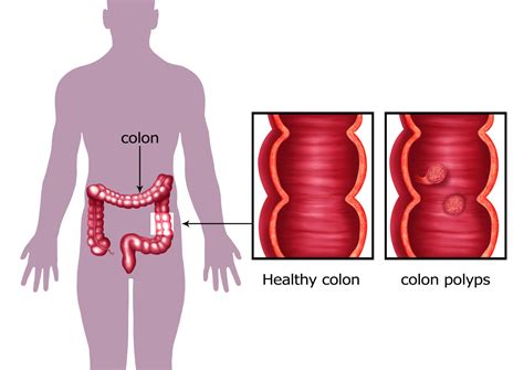 What Causes Colon Polyps Colorectal Cancer Specialists At Compass