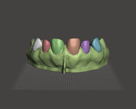 Segmented Anterior Veneer Preparation By Edm Dental Practice 3d Model