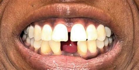 Everything You Need To Know About Zygomatic Implants Chicago Dental