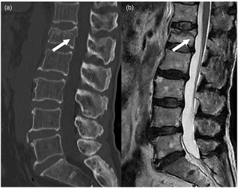 Osteoporotic Vertebral Compression Fracture Image Management Of