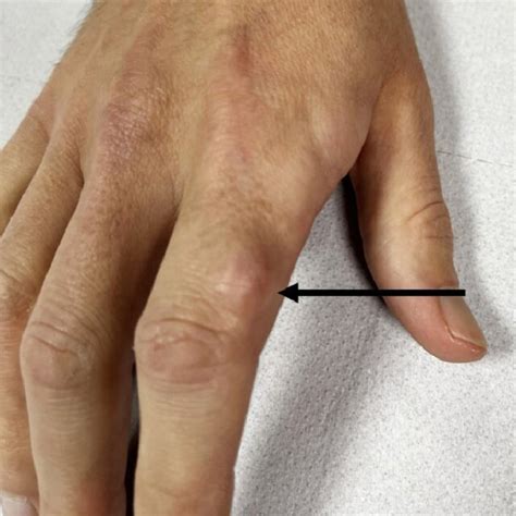 Visible Swelling On The Radial Aspect Of The Index Finger Black Arrow